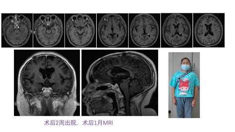 肖顺武教授：神经内镜扩大经鼻经视交叉下联合终板入路切除复发三脑室颅咽管瘤1例 脑医汇 神外资讯 神介资讯