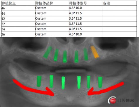 全口无牙颌种植病例 数字化种植中心的博客 Kq88口腔博客