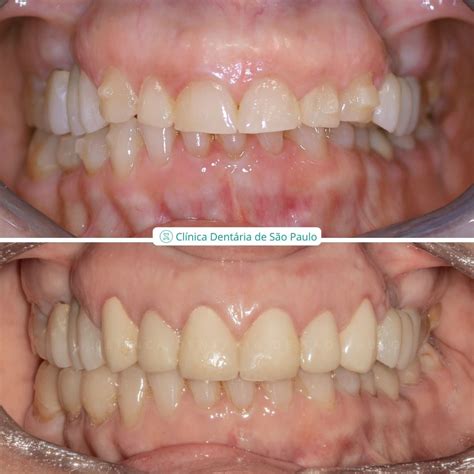 Periodontologia And Dentisteria Caso 1 Clínica Dentária São Paulo