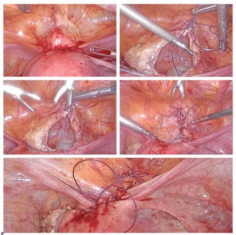Bladder Endometriotic Nodule Laparoscopic Resection And Suture