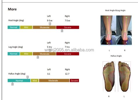 XSOL X Custom Diabetic Orthotic Insoles 3D Printed Support