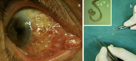 Adirofilaria Roundworm In Nasal Sub Conjunctival Space In The Right Eye