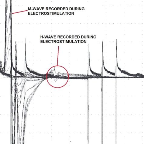 Comparison Of Axis II Assessment Of RDC TMD And DC TMD Adopted From Download Table