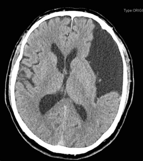 Brain Computed Tomography Brain Computed Tomography In Axial View