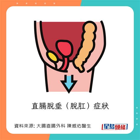 脱肛｜长期便秘可致脱肛不举 医生列7大症状：勿当痔疮 星岛日报