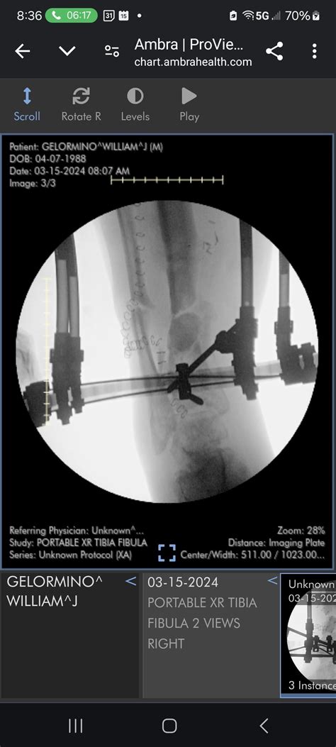 External Fixator R Brokenbones