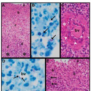 Microscopic Features Of Clinical Ulcerative Lesions Zoned Inflammatory Download Scientific