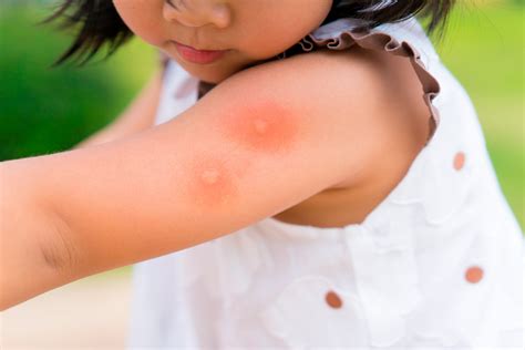 Cómo saber si una picadura de mosquito es grave Afterbite