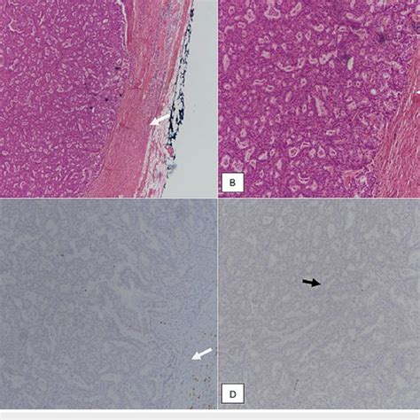Encapsulated Papillary Carcinoma A H And E Stained Section At 100x