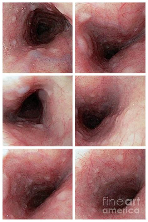Glycogenic Acanthosis 1 By Gastrolab Science Photo Library