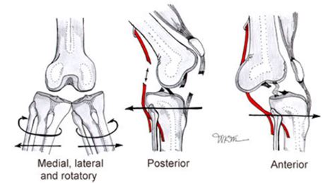 Knee Dislocation — Maimonides Emergency Medicine Residency