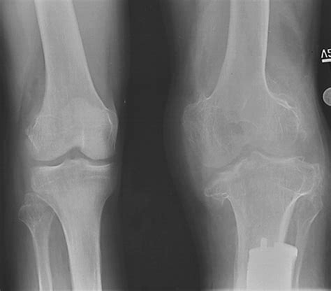 Proteus Syndrome X Ray