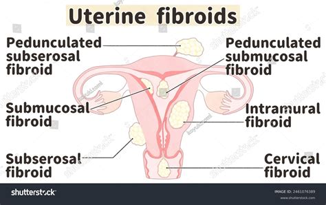 Types Uterine Fibroids Labeled Diagram Human Stock Illustration