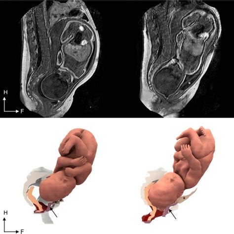 Imaging Of The Bladder Before Left And During Right The Second