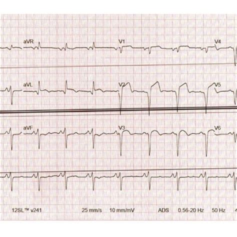 Abbreviation Ecg Electrocardiogram Download Scientific Diagram