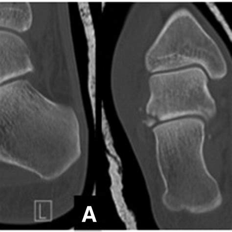 Pdf Lateral Subtalar Fracture Dislocation With Maintenance Of The Talonavicular Joint Case
