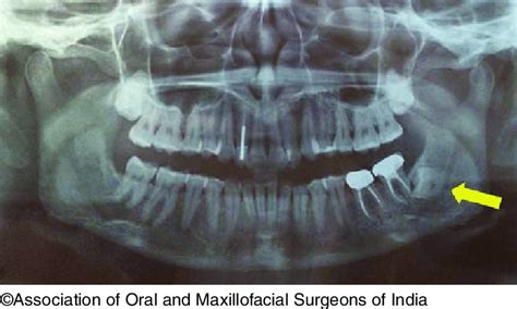 16 Opg Showing Impacted Mandibular Third Molar Displaying Only Crown Of Download Scientific