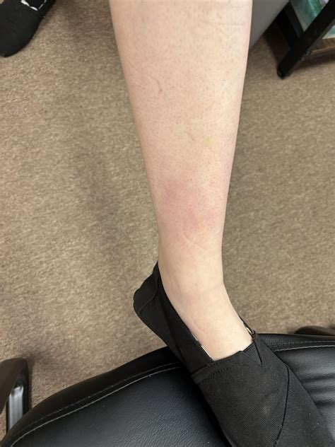 Help Lump Discoloration Rdermatologyquestions