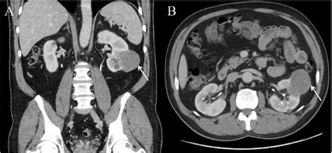 Preoperative Computed Tomography A Coronal B Axial Demonstrating A
