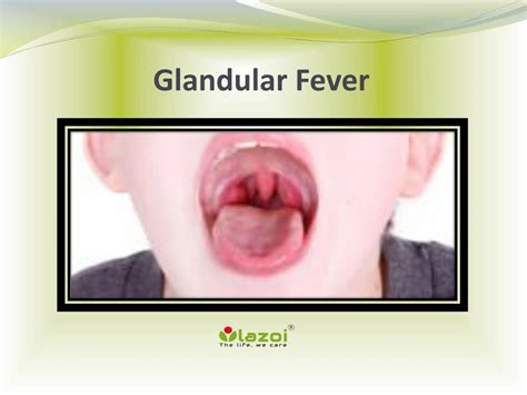Ppt Glandular Fever Powerpoint Presentation Free Download Id7953698