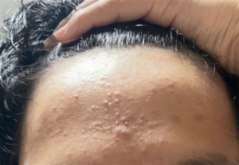 이마 좁쌀 여드름 해결하는 방법좀 알려주세요 ㅠㅠ 지식in