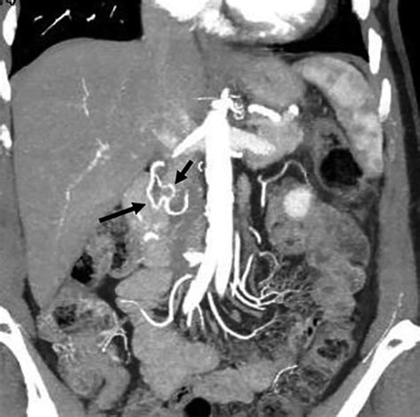Maximum Intensity Projection Mip Reconstruction Of A Ct Angiography