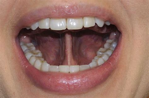 Clinical Oral Facial Massage