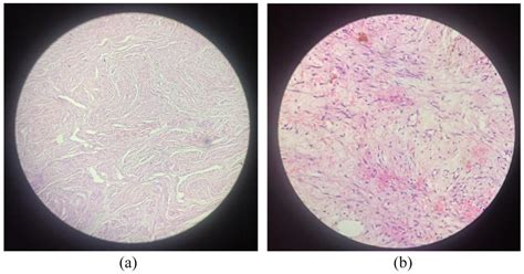 A Interlacing Fascicles Of Smooth Muscle Bundles Hande ×10 And B