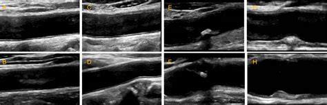 Frontiers A Deep Learning Algorithm To Identify Carotid Plaques And