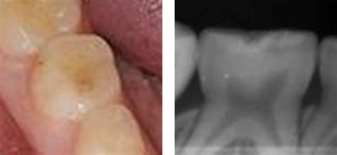 Primary Molars Occlusal Caries Prevention And Management Of Dental