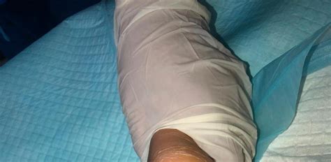 Madre Lanza Recaudación De Fondos Para Su Bebé Con Celulitis Y Absceso En Sus Piernas