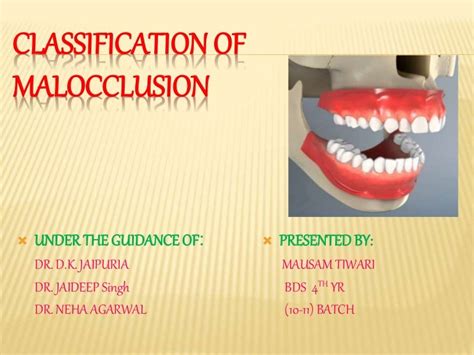 Classification Of Malocclusion