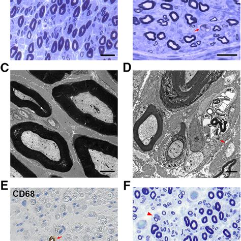 Pathological Alterations In Peripheral Nerves Of Elderly Humans A