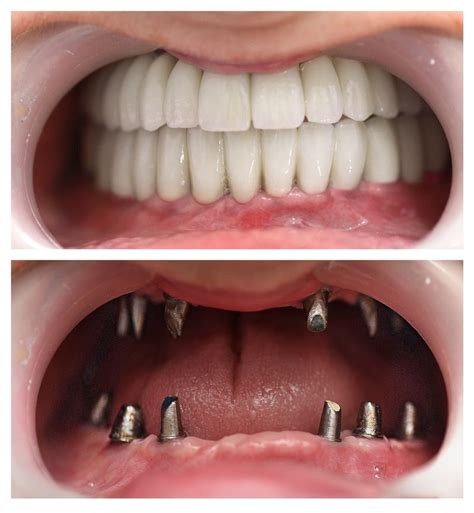 Guided Bone Regeneration London Dental Implant Institute