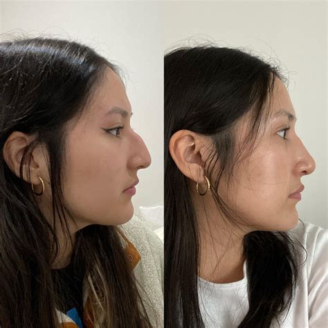 Rhinoplasty Swelling Progression 1 First Pic Profile Pre Op — 5m