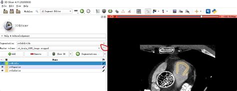 3d Slicer分割时在出现某区域无法分割的情况3d Slicer 分割时图形不符 Csdn博客 3d Slicer分割时在出现某区域无法分割的情况3d Slicer 分割时图形不符 Csdn博客