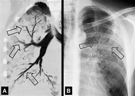 Fleischner Society Glossary Of Terms For Thoracic Imaging Radiology