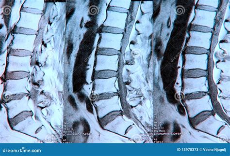 Mri Of Lumbar Spine Mr Stock Image Image Of Lumbar 13978373