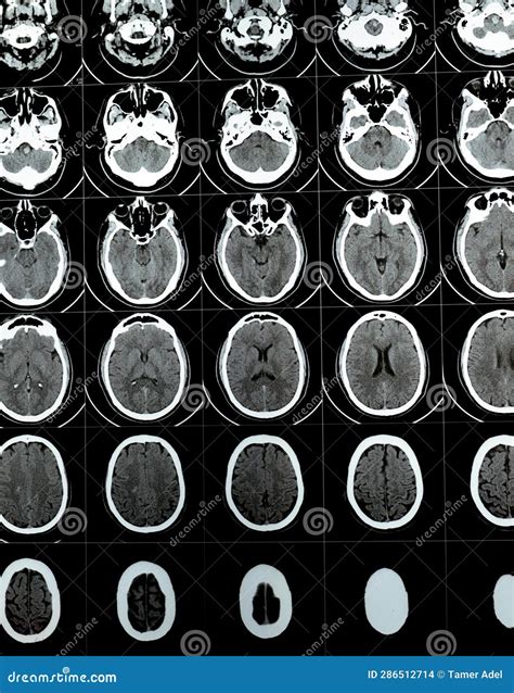 Multi Slice Ct Scan Of The Brain Showing Large Brain Stem And Right Centrum Semiovale Hematoma