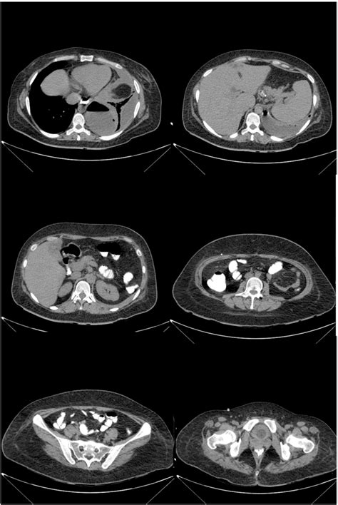 Clinical Evaluations Of Abdomen After Diaphragmatic Hernia Surgery