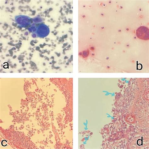 Scanty Cellular Smear Containing Enlarged Multinucleated Cells With