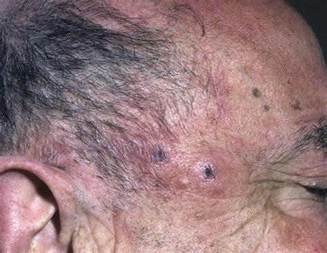 Frozen Section Temporal Artery Biopsy Reliably Indicates Giant Cell Arteritis Ophthalmology