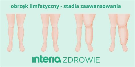 Obrzęki limfatyczne przyczyny objawy leczenie Zdrowie w INTERIA PL