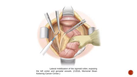Abdominoperineal Resection Pptx