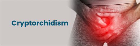 Understanding Cryptorchidism Causes Diagnosis And Treatment