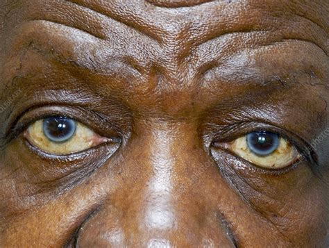 Arcus Senilis Of The Eyes Stock Image C023 8959 Science Photo Library