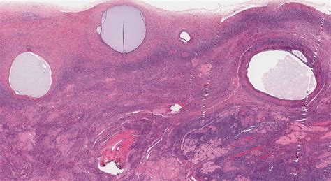 Cortical Inclusion Cysts Of The Ovary Ottawa Atlas Of Pathology