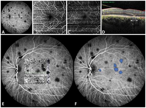 Choriocapillaris Flow Voids In Cryptococcal Choroiditis Using Optical