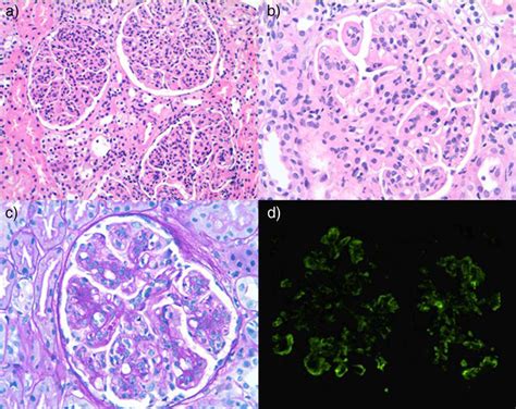 A Lobulated Glomeruli With Marked Diffuse Endocapillar Download