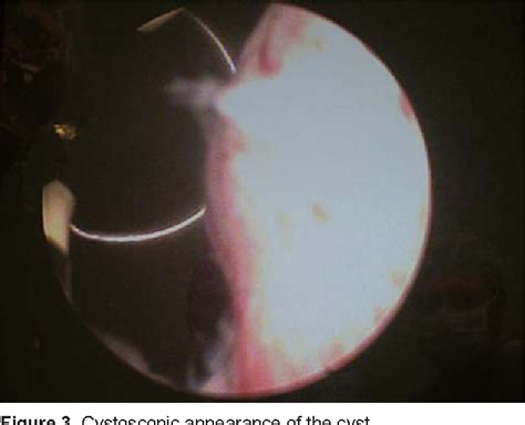 Prostatic Cyst Causing Severe Infravesical Obstruction In A Young Patient Semantic Scholar
